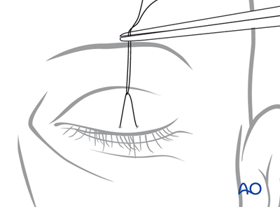 Weber Ferguson approach