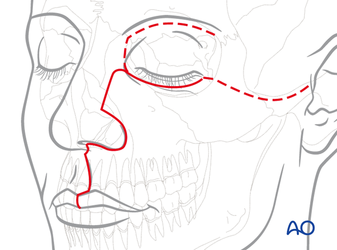 Weber Ferguson approach