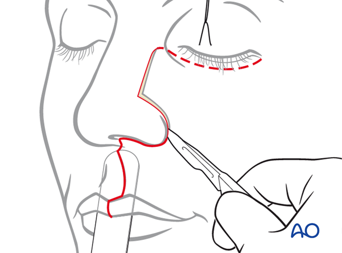 Weber Ferguson approach