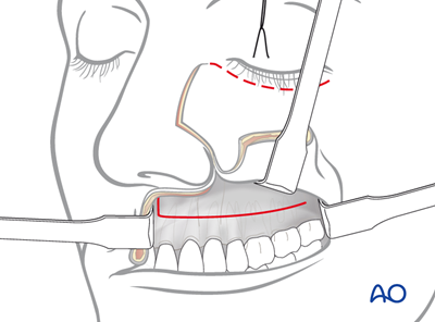 Weber Ferguson approach
