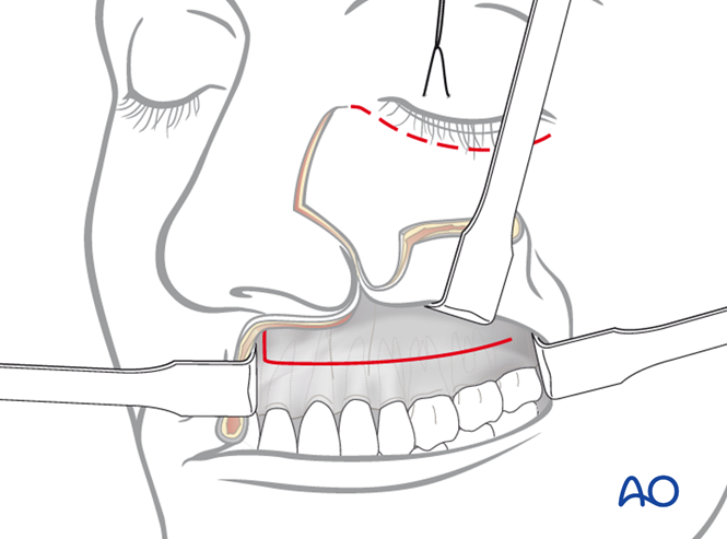 Weber Ferguson approach