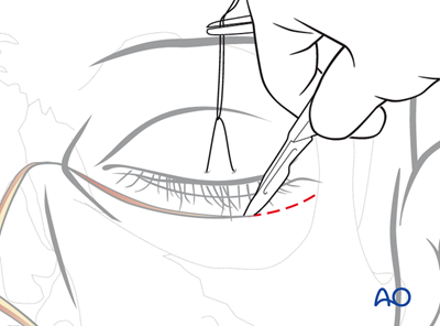 Weber Ferguson approach