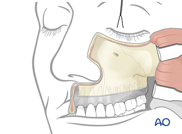 Weber Ferguson approach