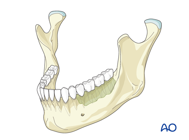 Marginal mandible, full thickness (double cortical)