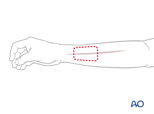 Radial forearm fasciocutaneous free flap for Marginal mandible, inner ...