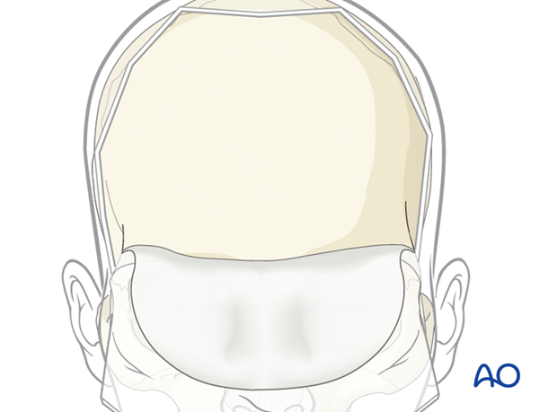 Pericranial and temporoparietal fascia flap for Anterior skull base ...