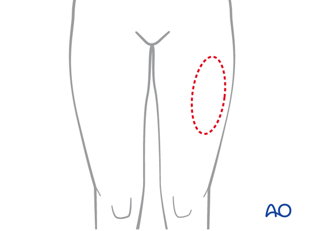 Anterolateral thigh fasciocutaneous free flap for Lateral mandible ...