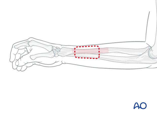Radial forearm osteocutaneous free flap for Brown II