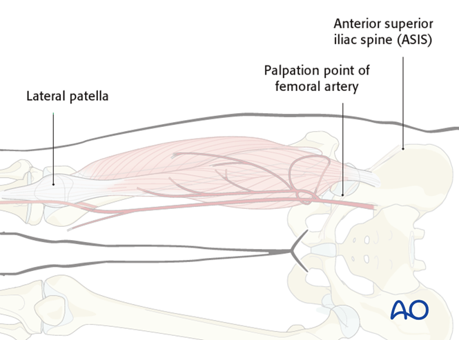 Anterolateral thigh flap harvest