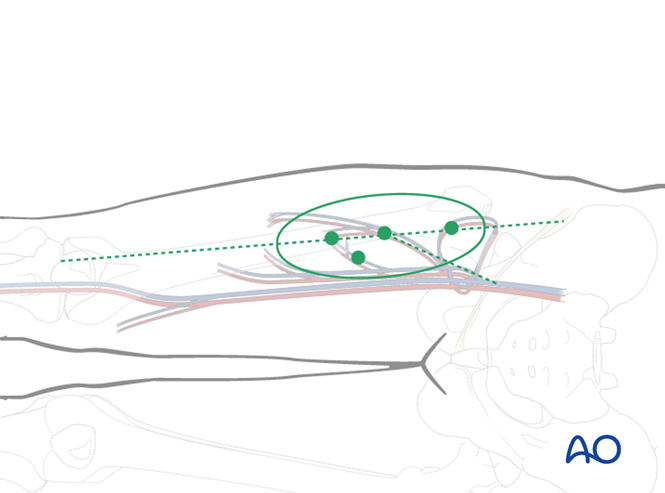 Anterolateral thigh flap harvest