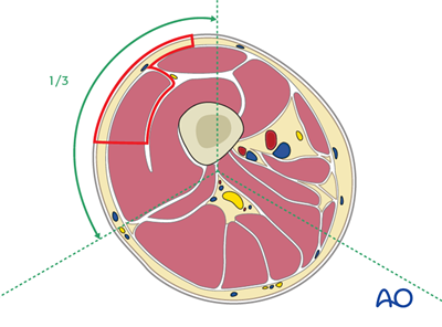 Anterolateral thigh flap harvest
