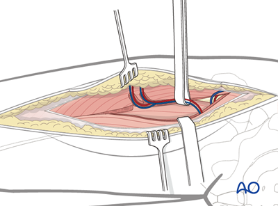 Anterolateral thigh flap harvest