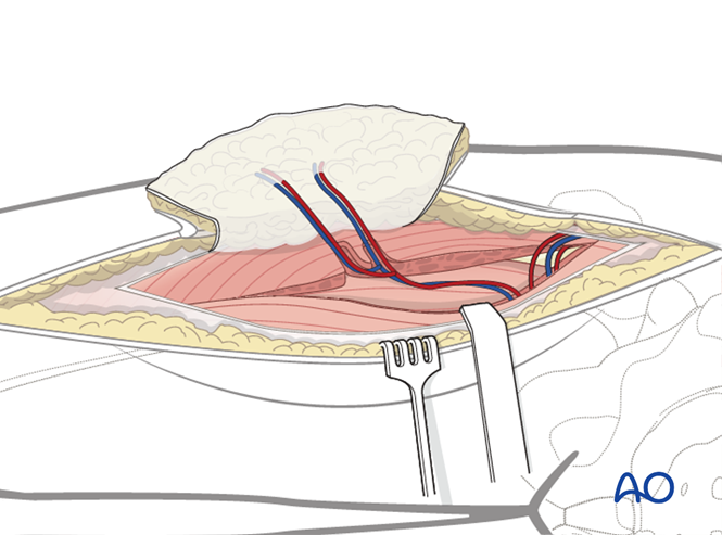 Anterolateral thigh flap harvest