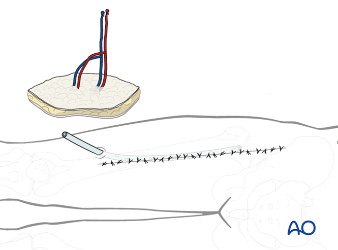 Anterolateral thigh flap harvest