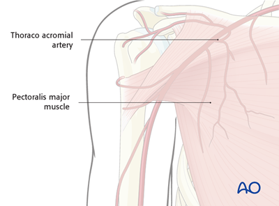 Pectoralis myocutaneous pedicle flap