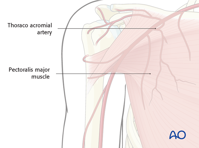 Pectoralis myocutaneous pedicle flap