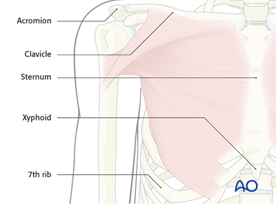 Pectoralis myocutaneous pedicle flap
