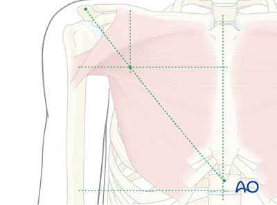 Pectoralis myocutaneous pedicle flap