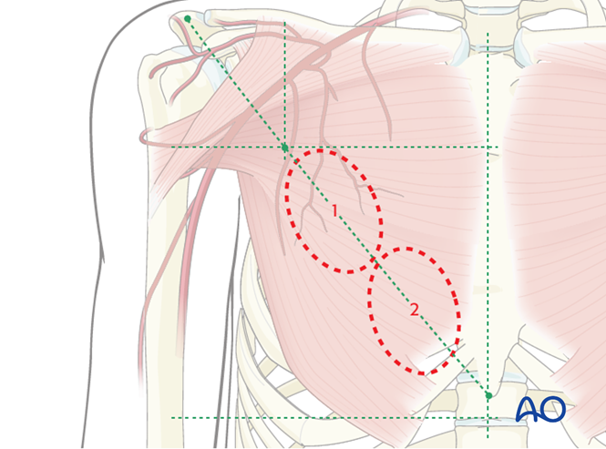 Pectoralis myocutaneous pedicle flap