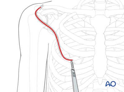 Pectoralis myocutaneous pedicle flap