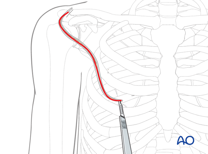 Pectoralis myocutaneous pedicle flap