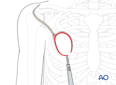 Pectoralis myocutaneous pedicle flap