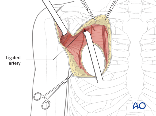 Pectoralis myocutaneous pedicle flap