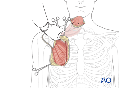 Pectoralis myocutaneous pedicle flap