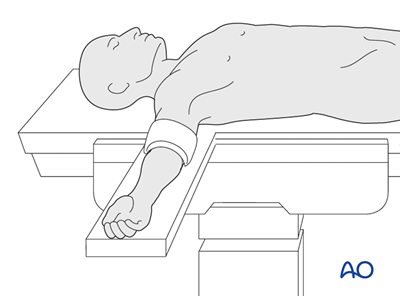 Radial forearm fasciocutaneous flap