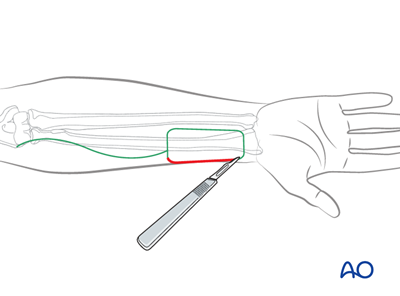 Radial forearm fasciocutaneous flap