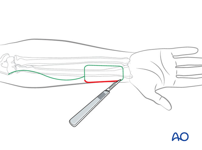 Radial forearm fasciocutaneous flap
