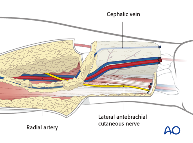 Radial forearm fasciocutaneous flap