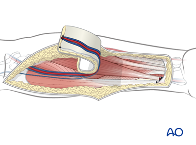 Radial forearm fasciocutaneous flap