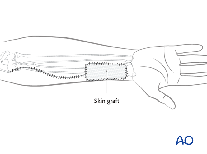 Radial forearm fasciocutaneous flap