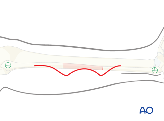 Fibula osteocutaneous flap harvest