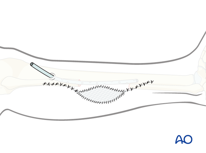 Fibula osteocutaneous flap harvest