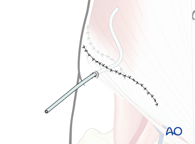 Iliac crest