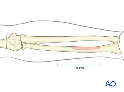 Radial forearm