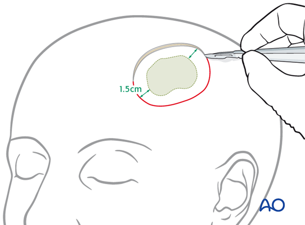 Scalp flap for Cranial vault