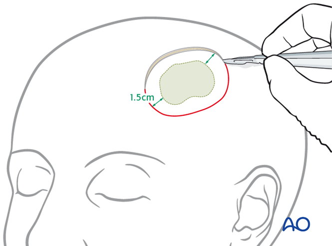 Scalp flap for Cranial vault