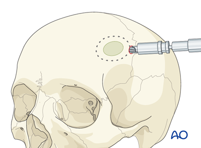 Scalp flap for Cranial vault