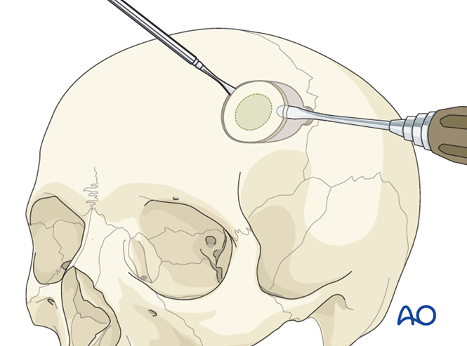Scalp flap for Cranial vault