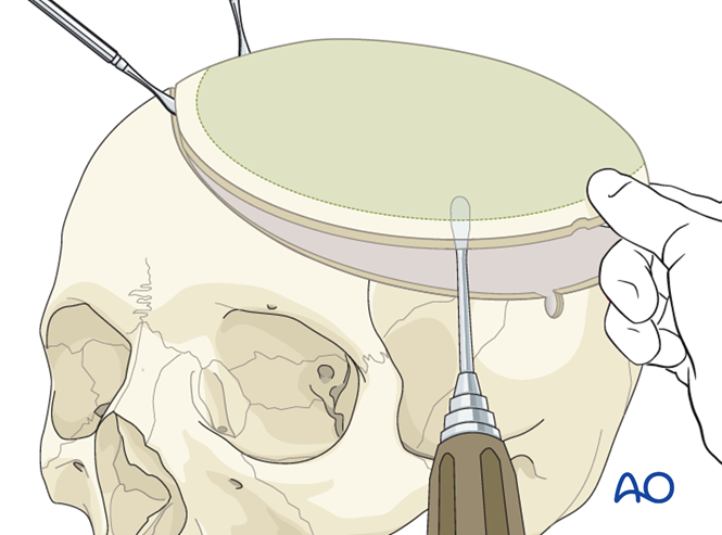 Latissimus dorsi fasciocutaneous free flap for Cranial vault