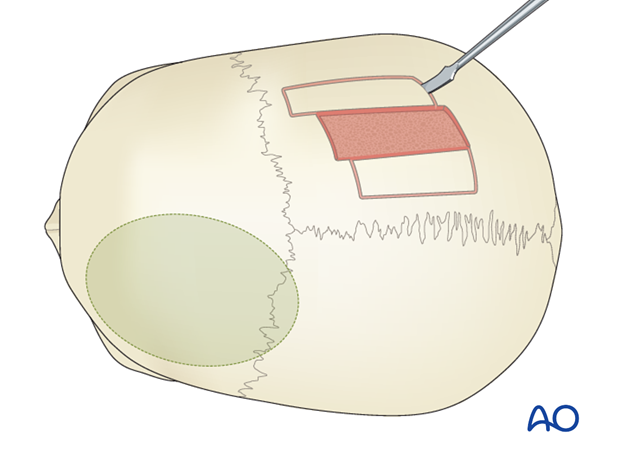 Scalp flap for Cranial vault