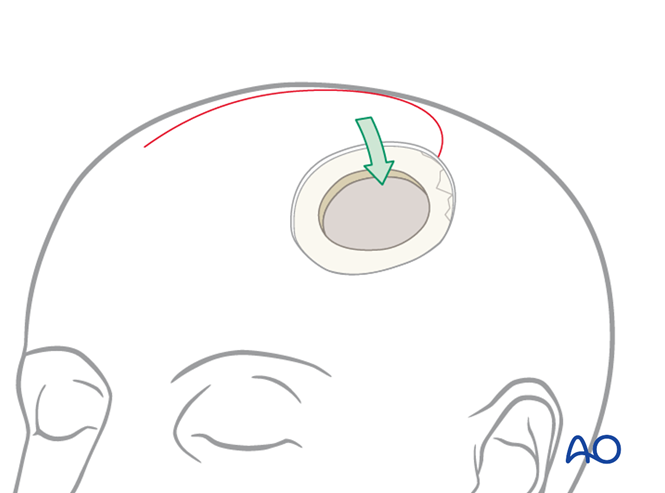 Scalp flap for Cranial vault