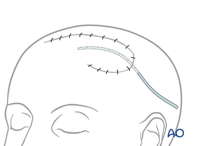 Scalp flap for Cranial vault