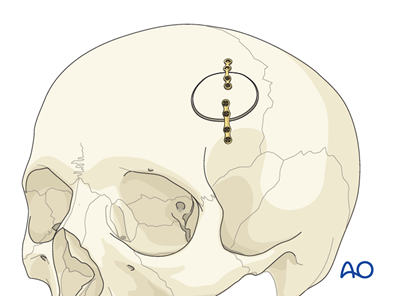 Scalp flap for Cranial vault