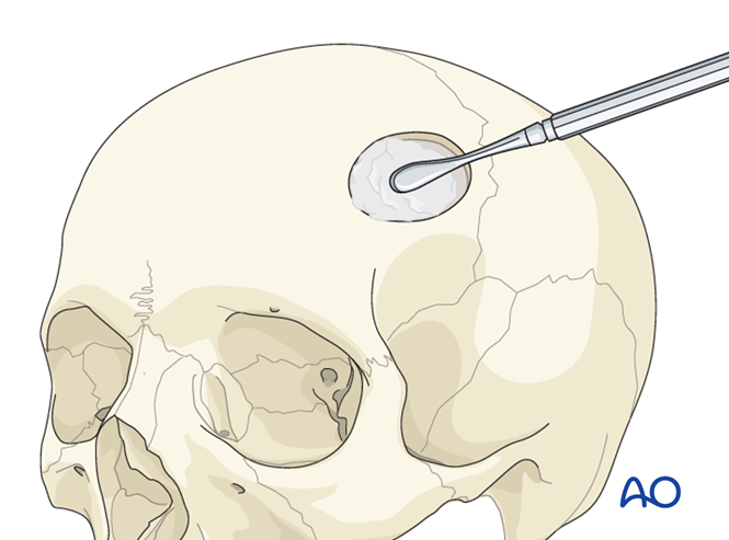 Scalp flap for Cranial vault