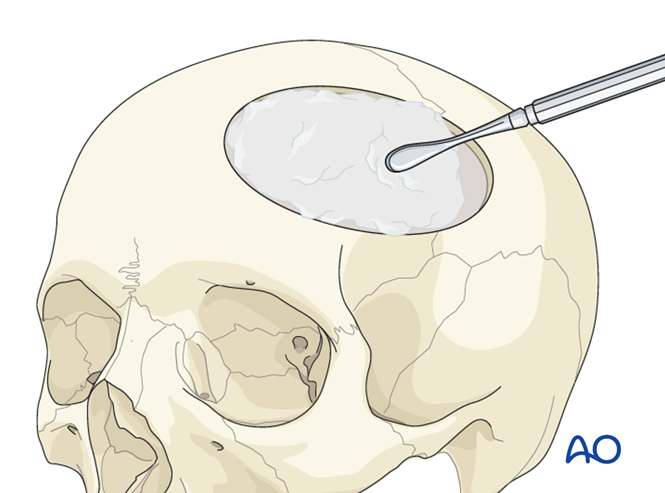 Radial forearm fasciocutaneous free flap for Cranial vault
