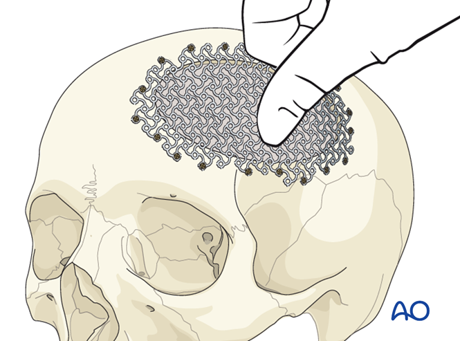 Radial forearm fasciocutaneous free flap for Cranial vault